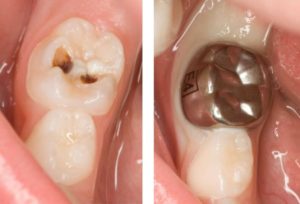 Stainless Steel Crowns for our Tiny Tots - Dr. Ashish Shah