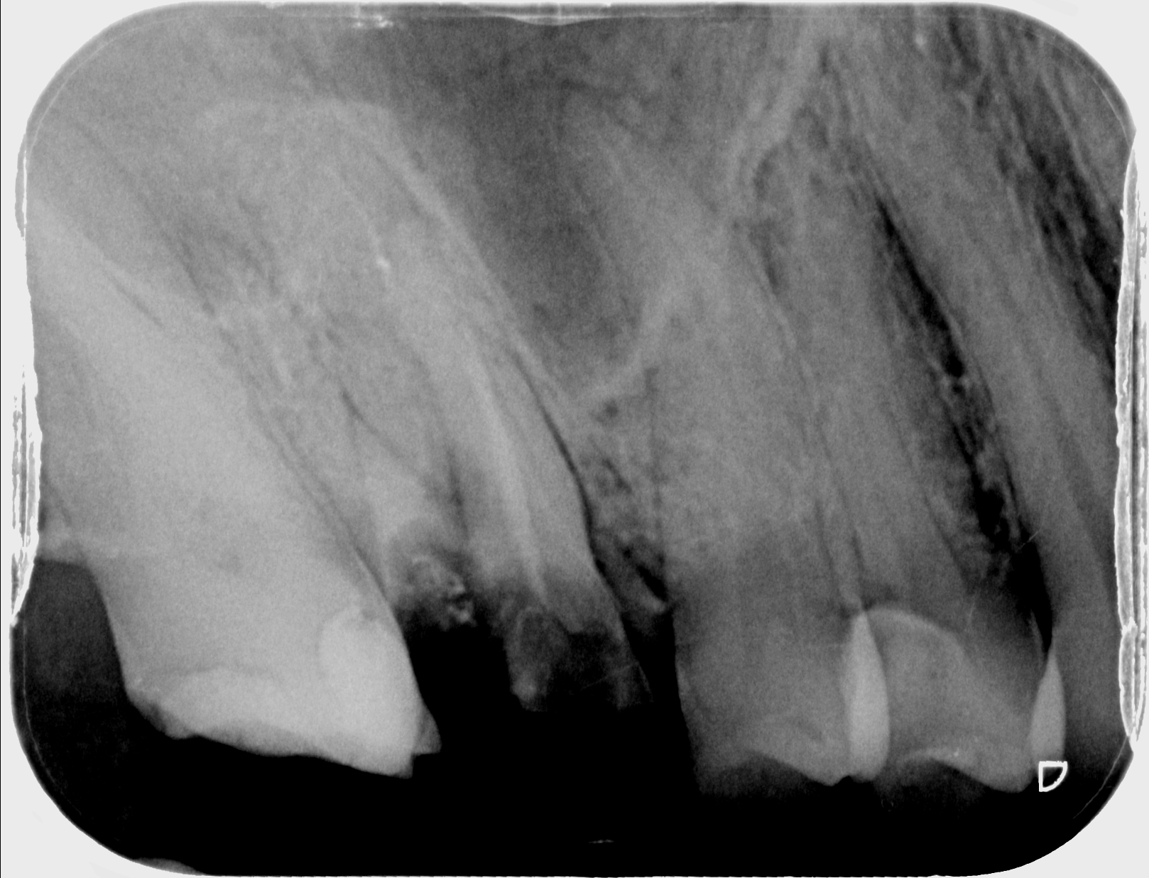 Immediate Implant in Upper Molar - Dr. Ashish Shah