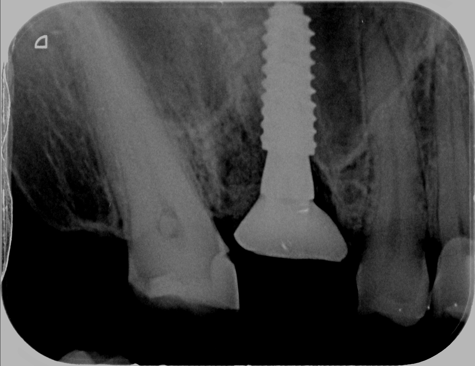 Immediate Implant in Upper Molar - Dr. Ashish Shah