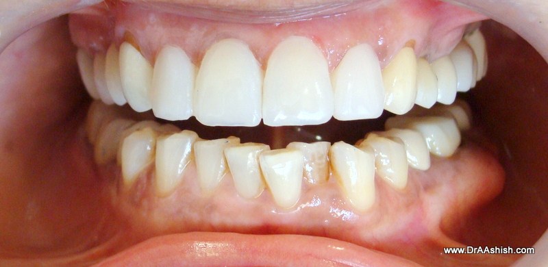 Chairside Single Sitting Veneers - Dr. Ashish Shah