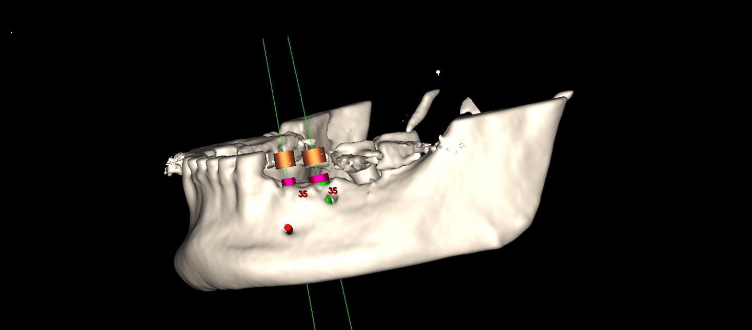 Computer Guided Implant Surgery - Dr. Ashish Shah