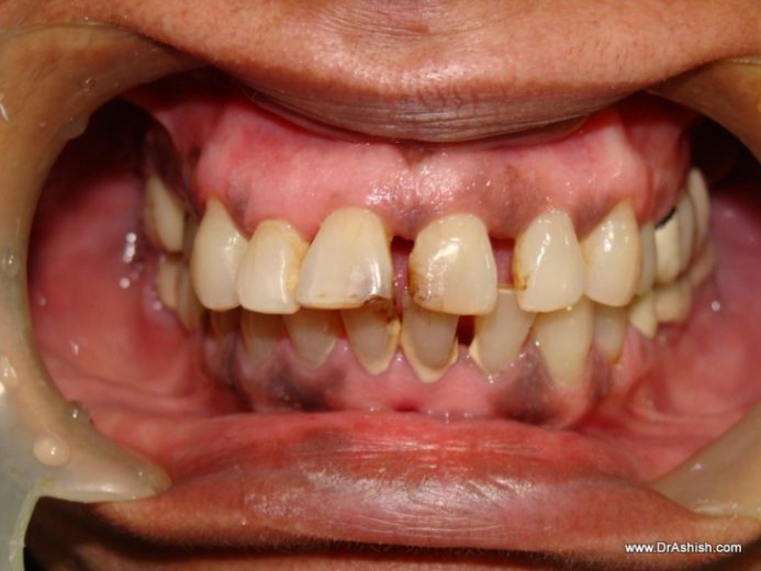 Cosmetic Correction of Flared Teeth - Dr. Ashish Shah