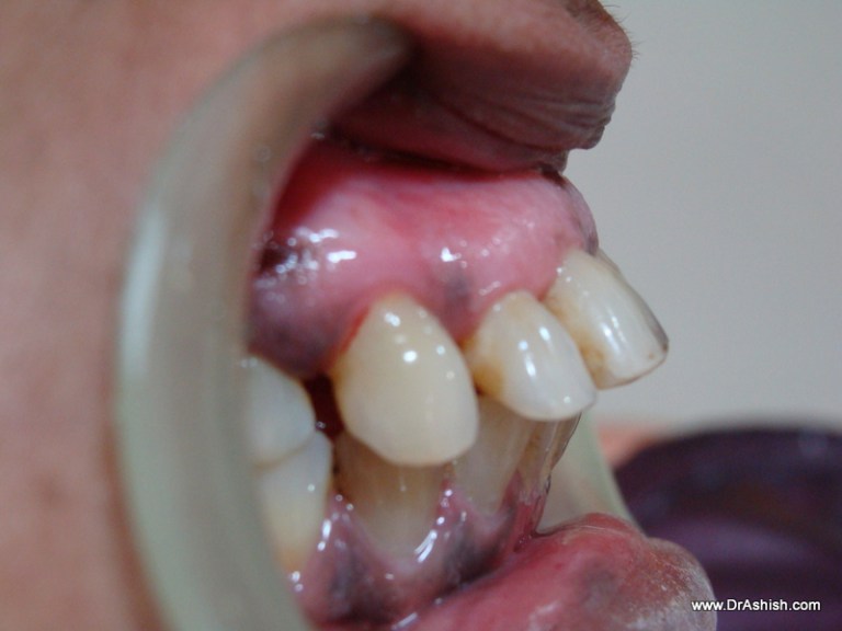 Cosmetic Correction of Flared Teeth - Dr. Ashish Shah & Associates
