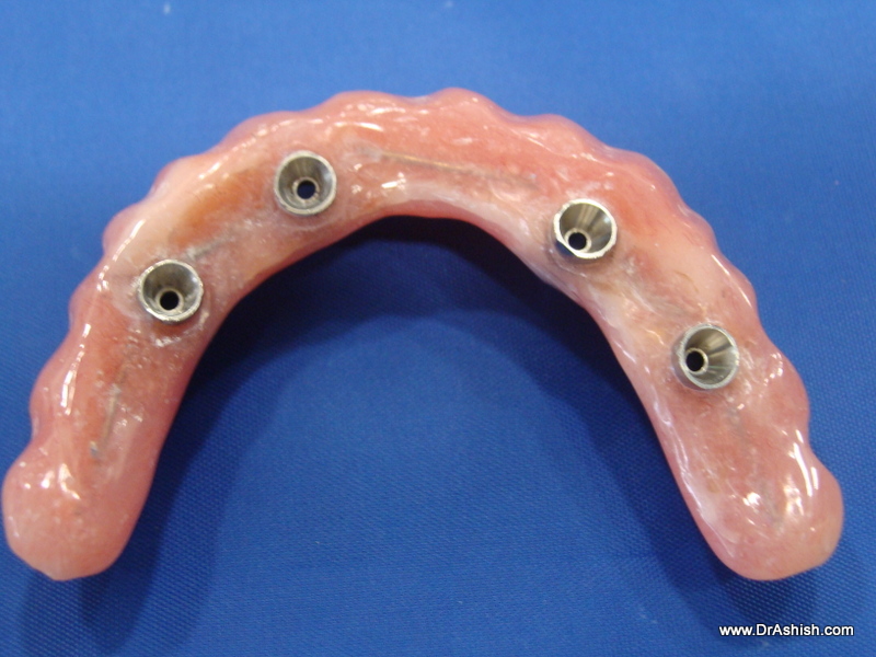 Denture To Fixed Teeth In A Day - Dr. Ashish Shah