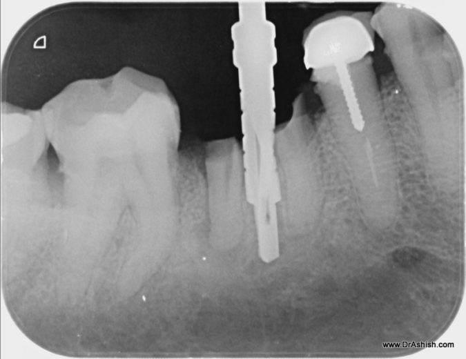 Immediate Implantation Through Mandibular Molar tooth - Dr. Ashish Shah