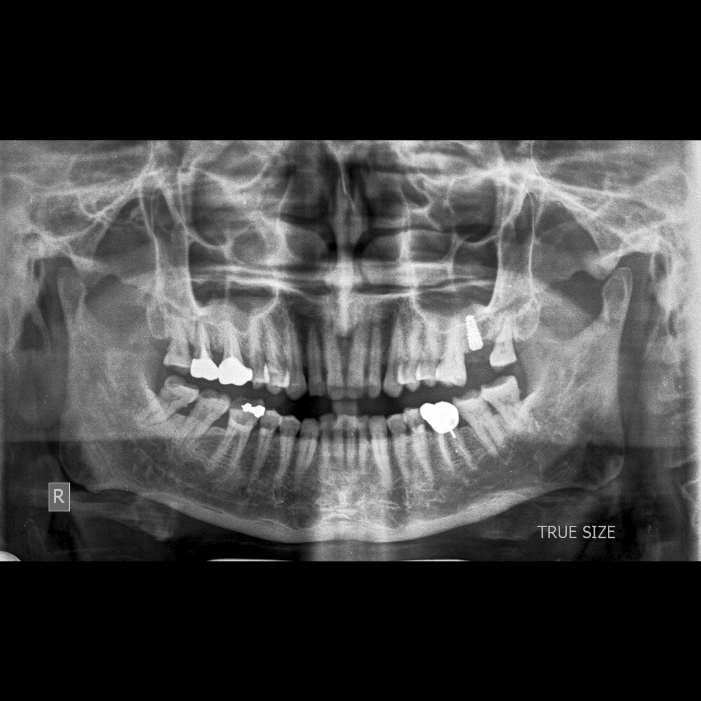 Indirect Sinus Lift with Hydraulic Pressure - Dr. Ashish Shah
