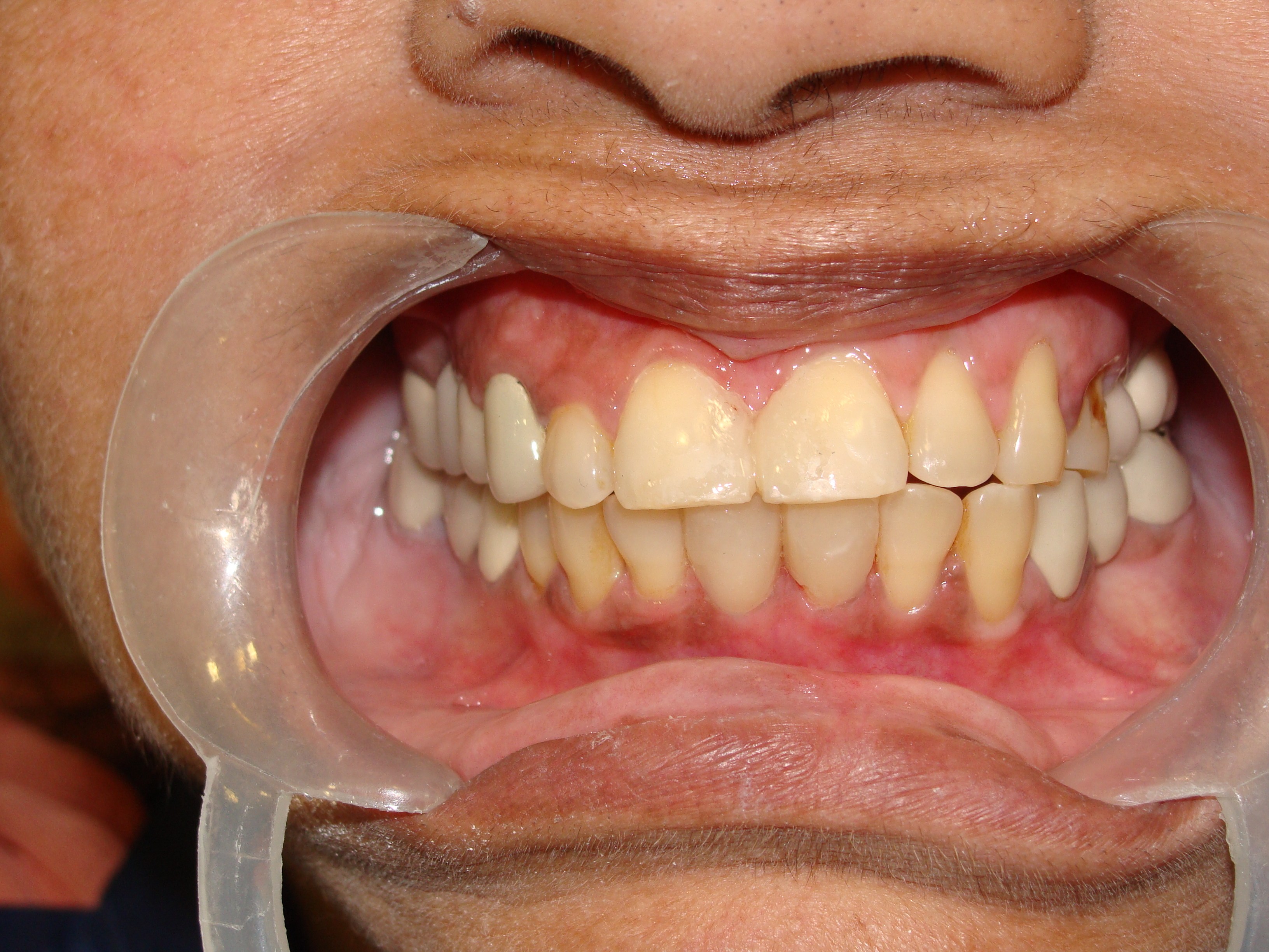 Closing The Gap In Front Teeth In One Visit Dr Ashish Shah
