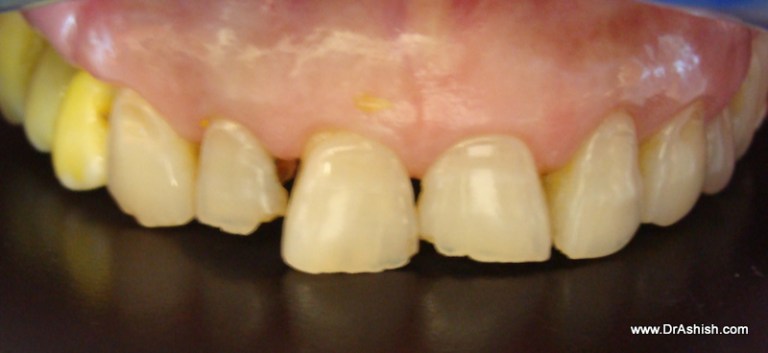 Treatment of Worn Teeth In Single Visit - Dr. Ashish Shah