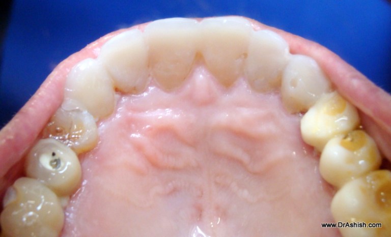 Treatment of Worn Teeth In Single Visit - Dr. Ashish Shah