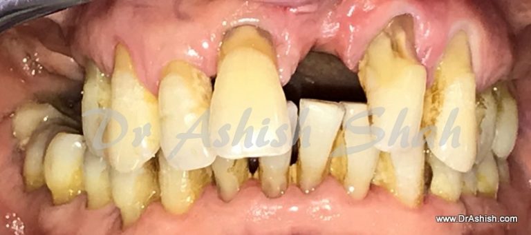 Full Arch Teeth on Just 4 Implants [Malo Bridge on All On 4 Implants ...