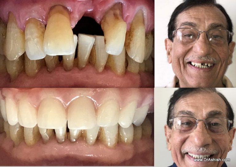 Full Arch Teeth on Just 4 Implants [Malo Bridge on All On 4 Implants ...