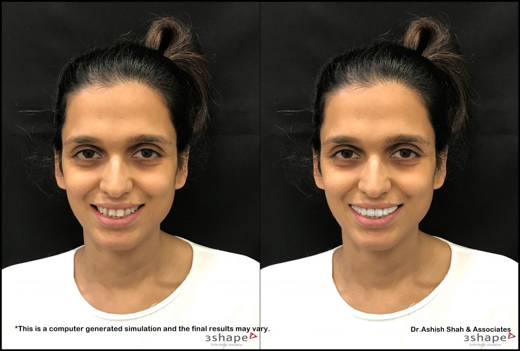 Digital Smile Simulation - Dr. Ashish Shah