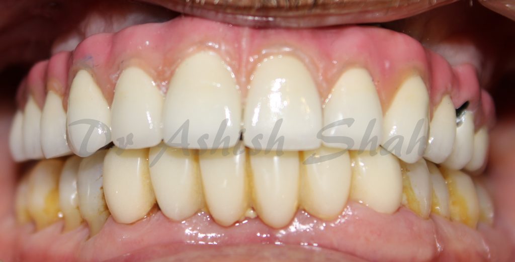 Full Arch Teeth on Just 4 Implants [Malo Bridge on All On 4 Implants ...