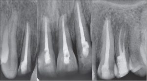 Emergency Root Canal Treatments - Dr. Ashish Shah