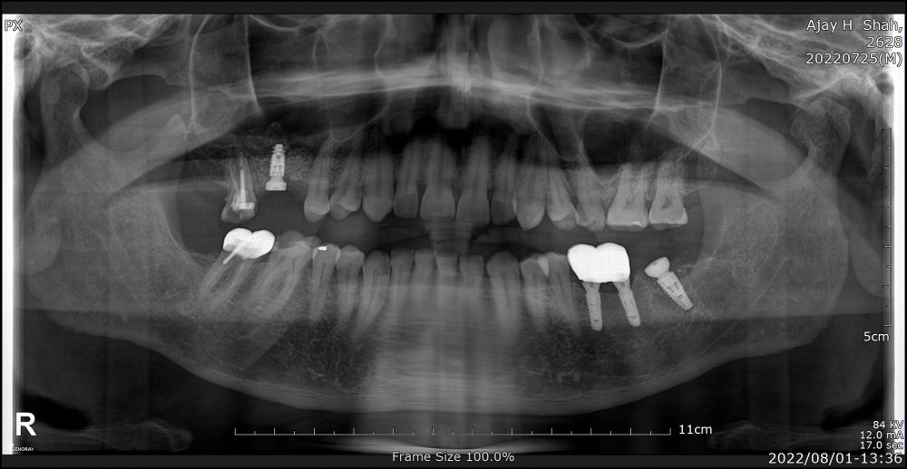 Immediate Implant in Upper Jaw Molar with Sinus Lift Surgery - Dr ...