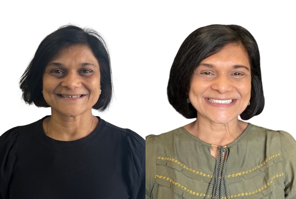 Implants Archives - Dr. Ashish Shah